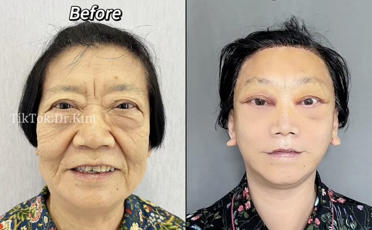 TikTok’s Elusive ‘Dr Kim’ Shares Post-Op Pics of $50,000 Facelift ...