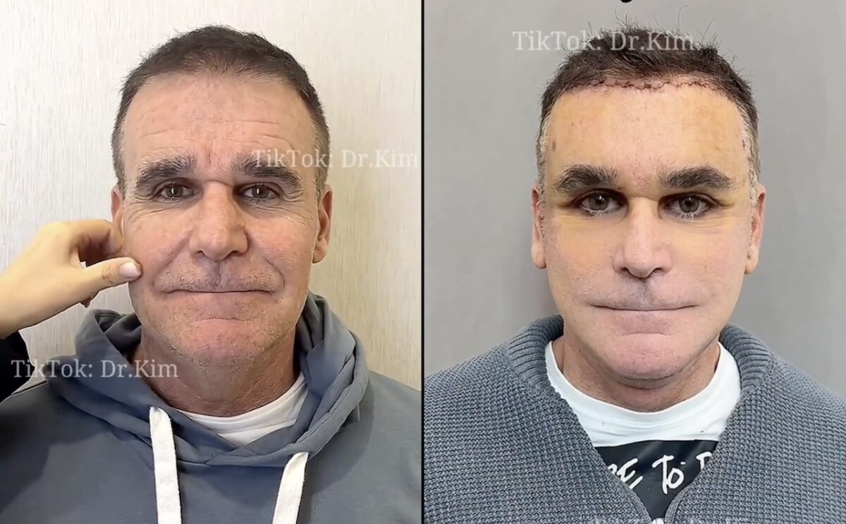 TikTok’s Elusive ‘Dr Kim’ Shares Post-Op Pics of $50,000 Facelift ...