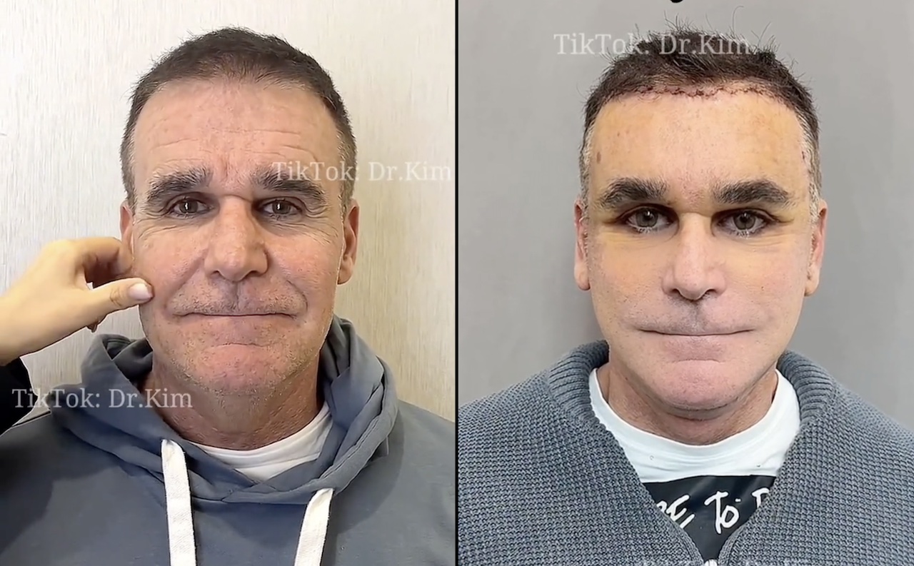 TikTok’s Elusive ‘Dr Kim’ Shares Post-Op Pics of $50,000 Facelift ...