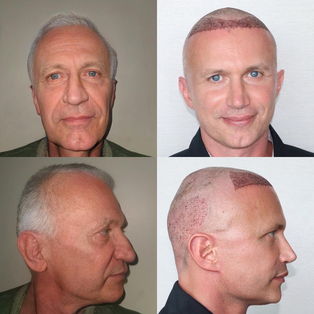 Surgeon Backs Turkish Facelift Pics Believed by Many to Be Digitally ...