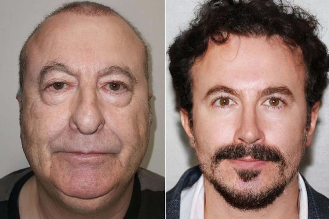 Turkish Surgeon Faked Viral Facelift Pics, Patient’s Lawsuit Says ...