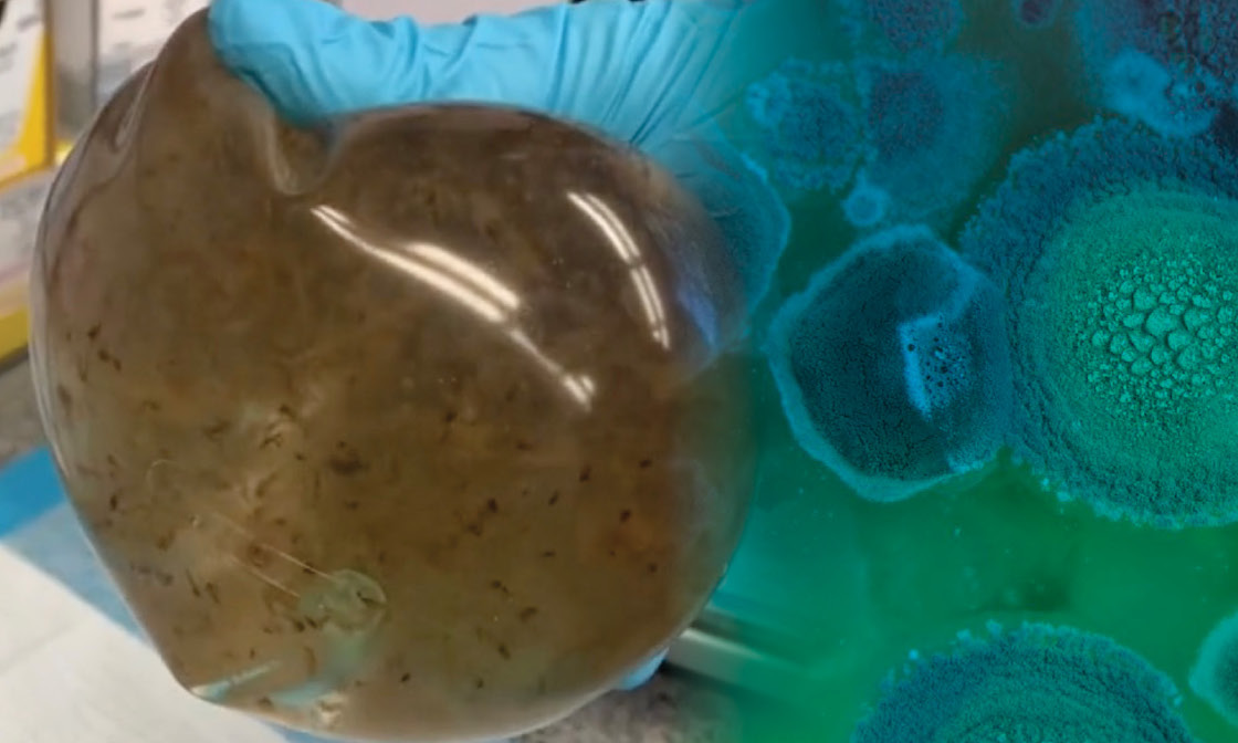 Moldy Breast Implants Came ‘Close to Killing Me’ - Surgical Times