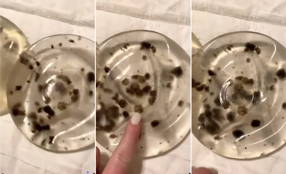 Breast Implants Spawn Swirling Mold Colonies - Surgical Times